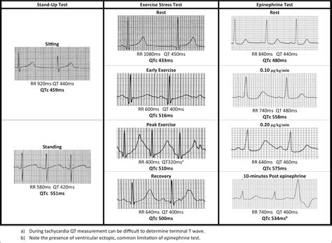 Provocation Testing In Congenital Long Qt Syndrome A Practical Guide