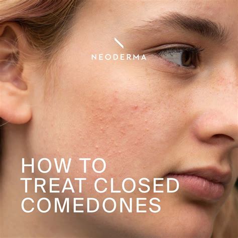 treatment of closed comedones — neoderma neoderma medium