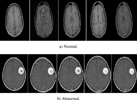 Figure 1 From A Brain Abnormality Detection And Tissue Segmentation Technique By Using Dual Mode
