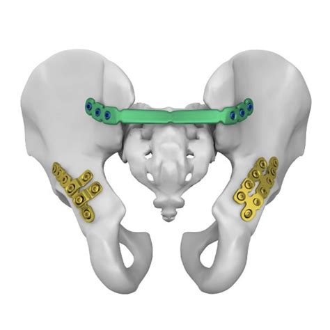 Placa De La Articulación Sacroilíaca Ⅱ Aravon Medical