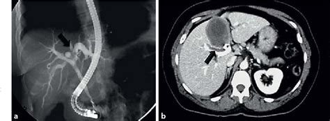 Figure 1 From Frank Intrabiliary Rupture In Liver Hydatidosis Located