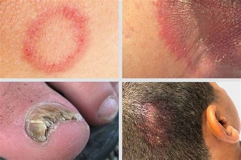 Treatment For Tinea In Men Skin Care Network