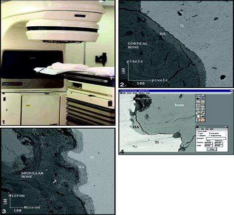 Histomorphometric Analysis Of Ha Coated Implants Interface W