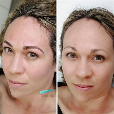 Gallery Combination Brows The Brow Clinic