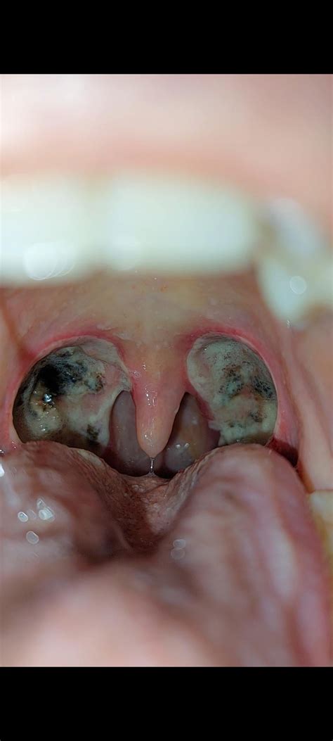 Exposed Blood Vessel After Tonsillectomy Scab Came Off And Several