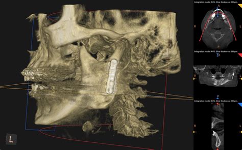 Broken Jaw Displaced Subcondylar Fracture Of The Mandible Broken Jaw Displaced Subcondylar