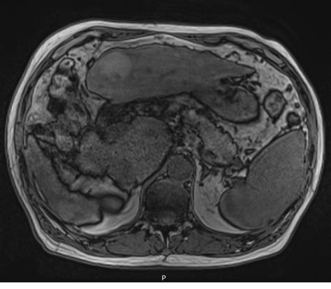 Hepatocellular Carcinoma Hcc Mri