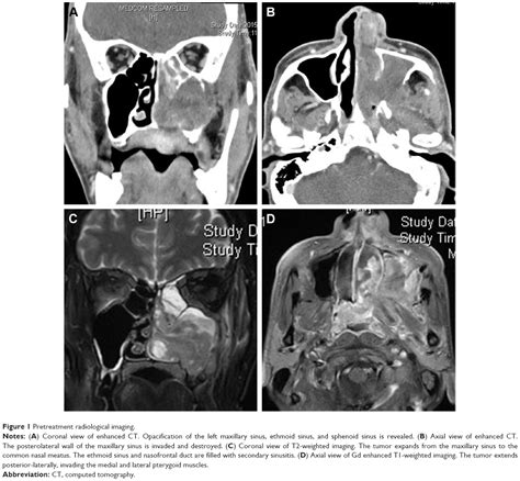Synovial Sarcoma Of The Maxillary Sinus An Extremely Rare Case With Ott