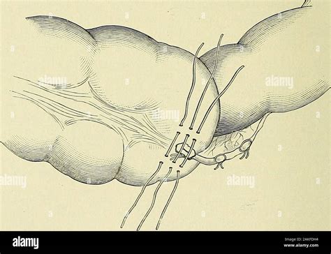 Meso Appendix Hi Res Stock Photography And Images Alamy