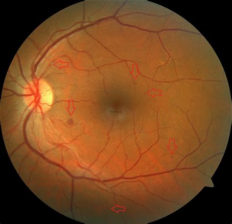 Hypertensive Retinopathy Malignant Hypertension Retinara