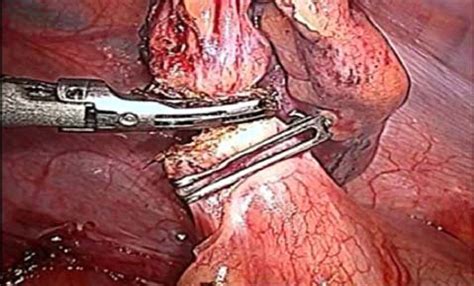 Cutting Off The Appendix Above The Clip With A Harmonic Scalpel Fig 1 Download Scientific