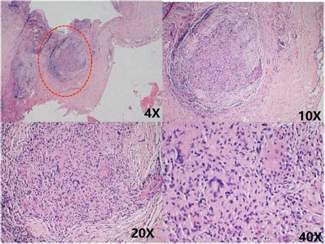 Chronic Inflammatory Cell Infiltration Was Seen In The Connective