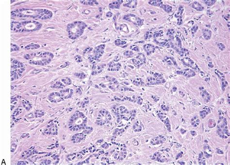 Invasive Breast Cancer Oncohema Key