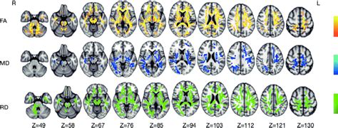 Comparison Of Diffusion Tensor Imaging Indices Fa Md Rd Between Pd Download Scientific