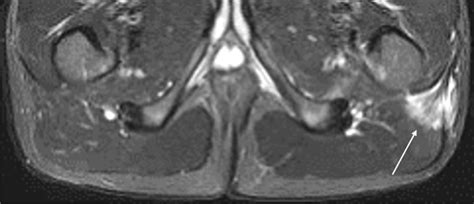 Pelvic Enthesitis In A 15 Year Old Boy With Juvenile Idiopathic