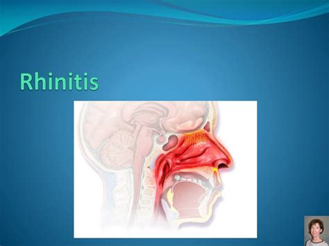 Ppt Rhinitis Types Symptoms And Treatment Options Powerpoint