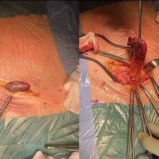 Intraoperative Pictures Of A Year Old Woman Who Presented With Download Scientific Diagram