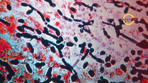 Risiko Infeksi Sdki D0142