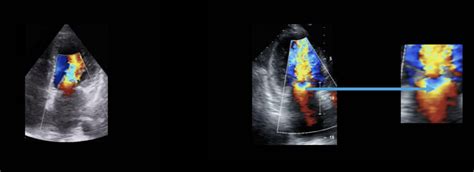Echo Basics Mitral Stenosis LITFL Radiology Library