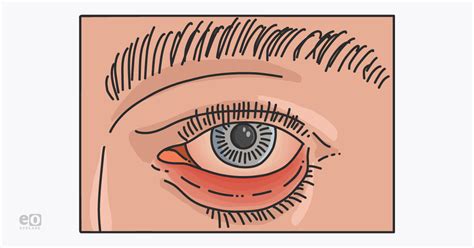 A Clinical Guide To Ectropion