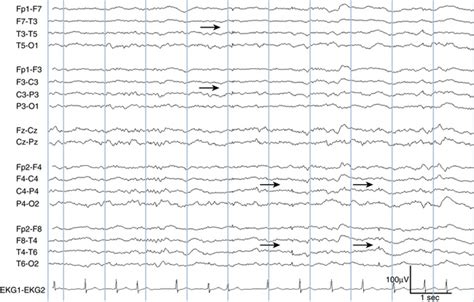 Normal Variants In The Electroencephalogram Neupsy Key