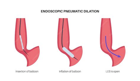 Premium Vector Endoscopic Pneumatic Dilation Upper Endoscopy