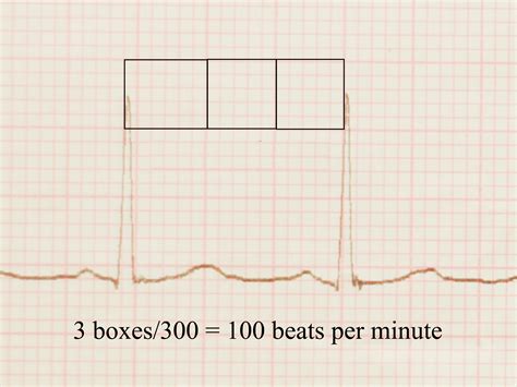 Belajar Cara Membaca Hasil Ekg Breadelectro