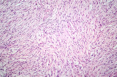 Photomicrograph Of A Giant Cell Tumor Of Bone Revealing Its Cellular
