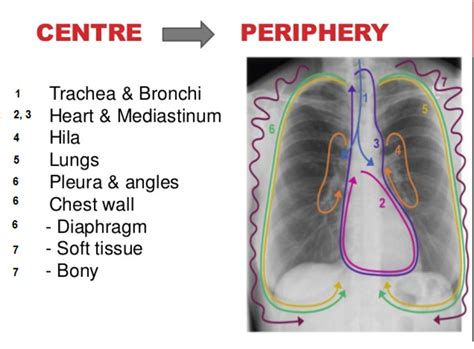 How To Read Chest X Rays At Ronald Mulligan Blog