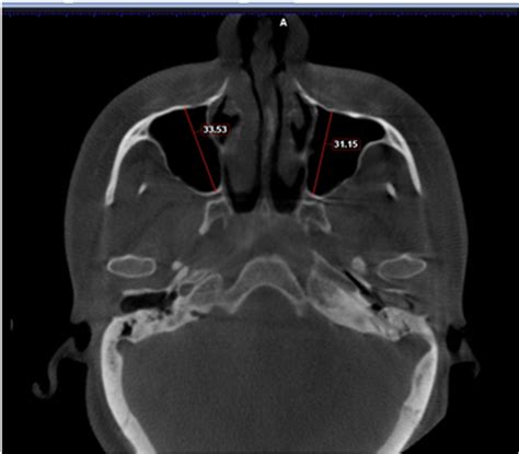 Figure Showing The Depth Distance In Axial Cut The Role Of Cone Beam Computed Tomography In
