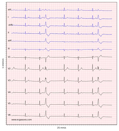 Can Someone Have Both Sinus Arrhythmia And Sinus Bradycardia Is That Considered Normal R