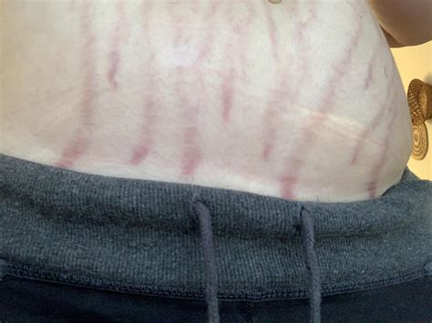 Cushings Stretch Marks R Cushings