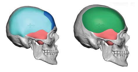 Custom Forehead Temporal Implants Replacement Design Side View Dr Barry Eppley Indianapolis