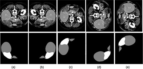 CSSE Free Full Text Liver Tumor Segmentation Based On Multi Scale