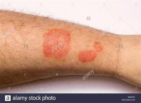 Psoriasis Skin Close Up Of A Rash And Scaling On The Patients Skin The Concept Of Chronic