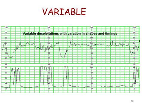 Ppt Electronic Fetal Monitoring Efm Cardiotocographyctg