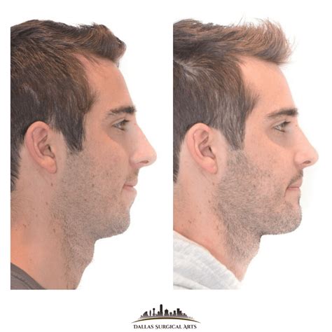 Jaw Repositioning Orthognathic Surgery Dallas Surgical Arts