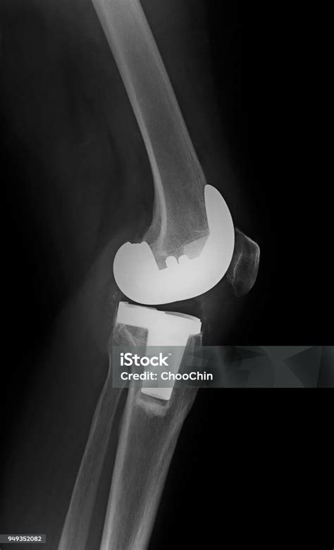 Xray Image Of Total Knee Arthroplasty Total Knee Replacement Side View