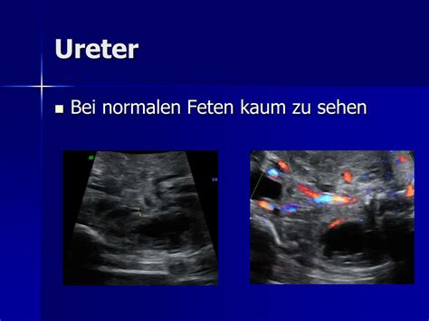 PPT - Fehlbildungen des Urogenitaltaktes PowerPoint Presentation - ID ...