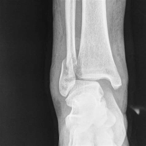 Fractura En La Metáfisis Distal Del Peroné Y Ligamentos Del Tobillo Rotos Dr Jose Mario