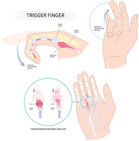 Trigger Finger Definition Etiology Symptoms Diagnosis Evaluation And Trigger Finger Definition Etiology Symptoms Diagnosis Evaluation And