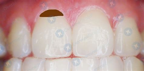 G V Blacks Classification Of Caries Examinedental