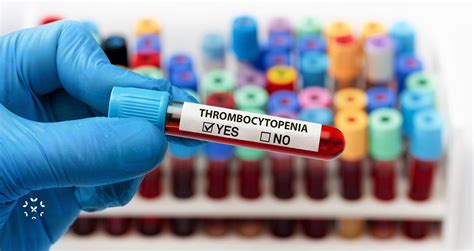 Lupus And Thrombocytopenia Kaleidoscope Fighting Lupus