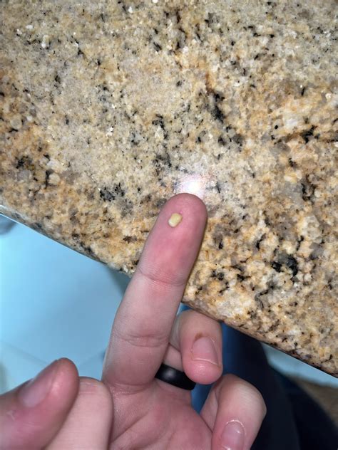 Tonsil Stone Rtonsilstones