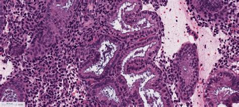 Proliferative Endometrium Histology