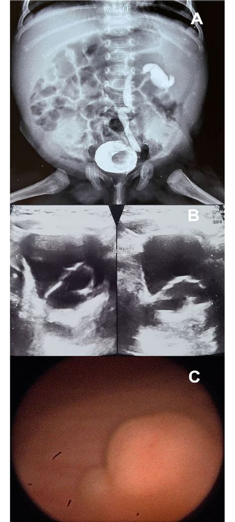 Endoscopic Decompression Ureterocele At Phillip Pusey Blog