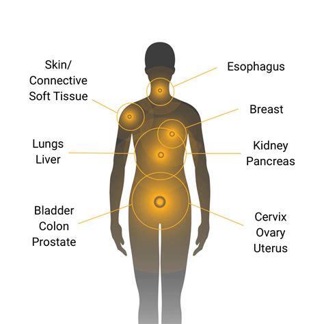 Advanced Malignant Perivascular Epithelioid Cell Cancer