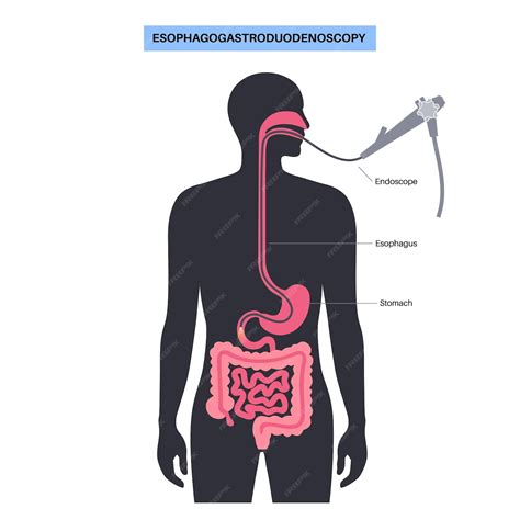 Afiche Médico De Esofagogastroduodenoscopia Diagnóstico Endoscópico