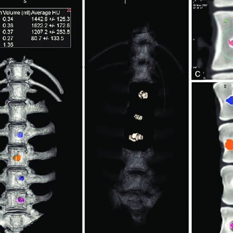 Three Dimensional Computed Tomography Scans For Volumetric Measurement Download Scientific