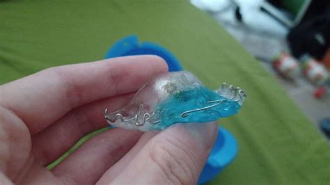 I Got The Braces The Good Thing For Me Is That I Only Needed The